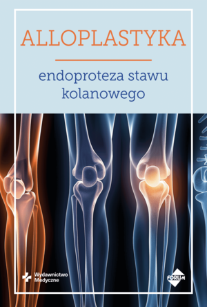 Alloplastyka – endoproteza stawu kolanowego - Wydawnictwo Medyczne ...